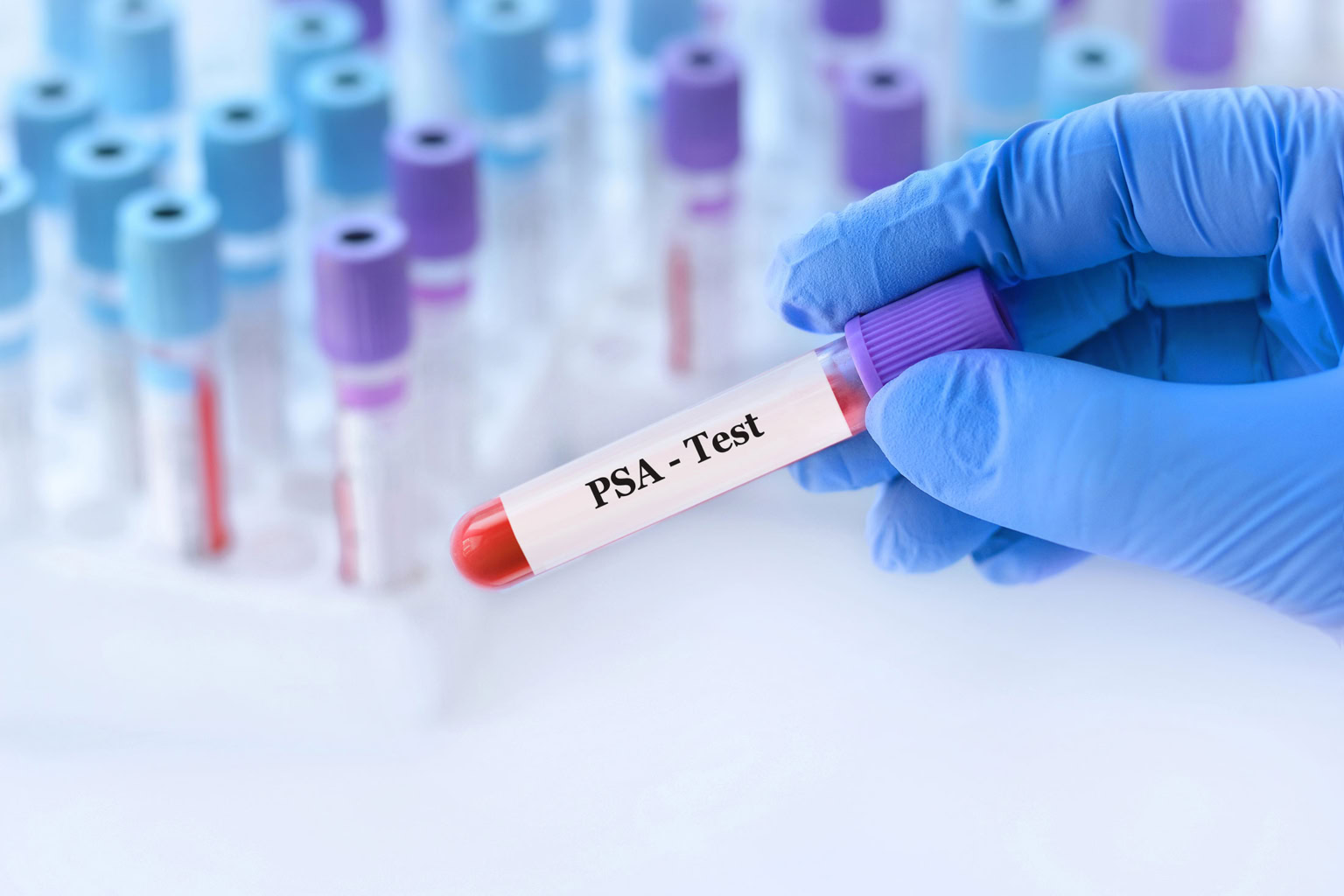 PSA Test Explained: Understanding the Prostate-Specific Antigen Test ...
