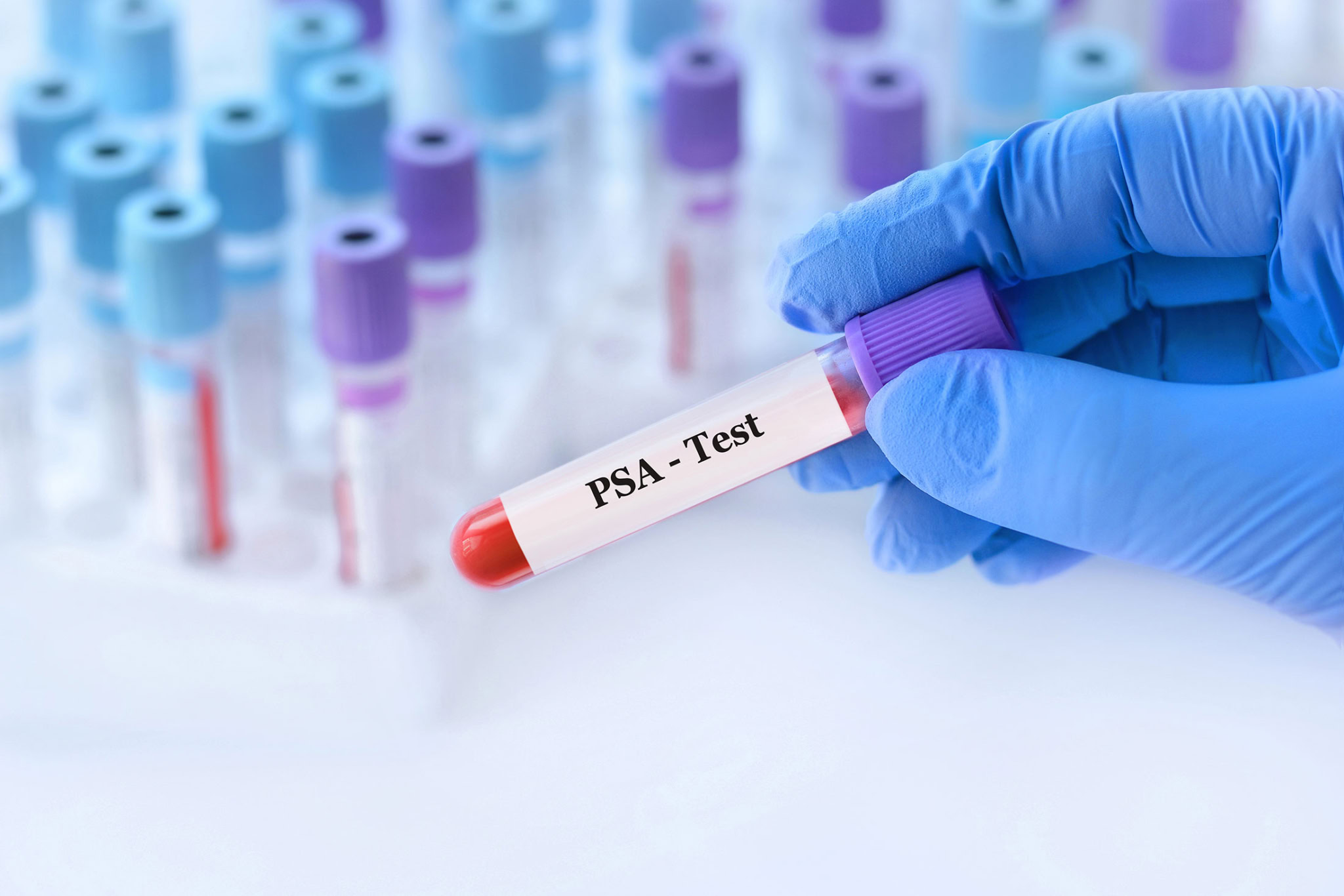PSA Test Explained: Understanding the Prostate-Specific Antigen Test ...